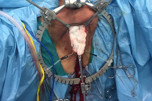 Mini-Bookler® URO/GYN Basic Surgery System – Mediflex Surgical Products